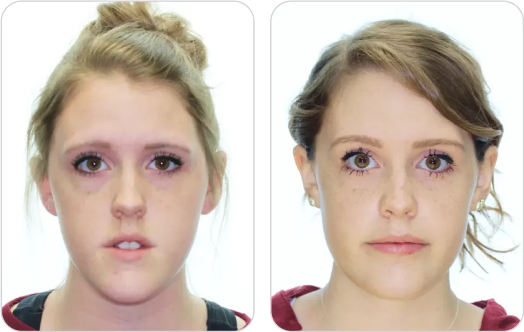 Maxillary Hypoplasia 9 | Movahed OMS